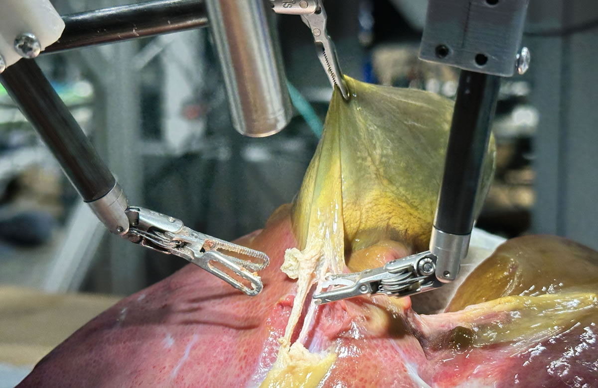 Avance histórico en cirugía: robot autónomo opera sin ayuda humana directa